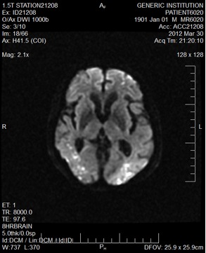 Fat Embolism Syndrome | Fenire | The Southwest Respiratory and Critical ...