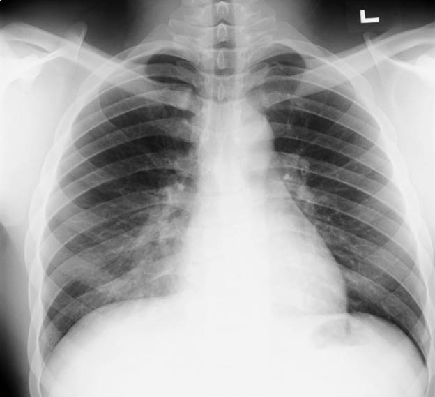 Multiple pulmonary contusions in a collegiate football player | Phy ...